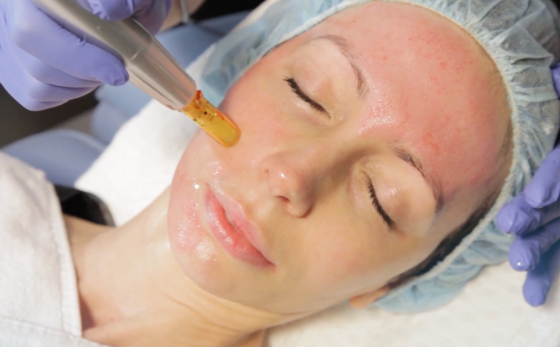 Skin Needling | Treatment | Aspire Training Clinic